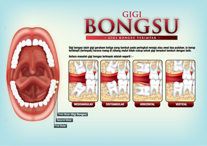 > SAMBUNGAN KISAH PEMBEDAHAN GIGI GERAHAM BONGSU (TAHUN 2014) & TIPS ...