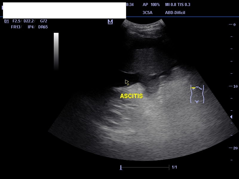 EcoCyl-Grupo: Ascitis