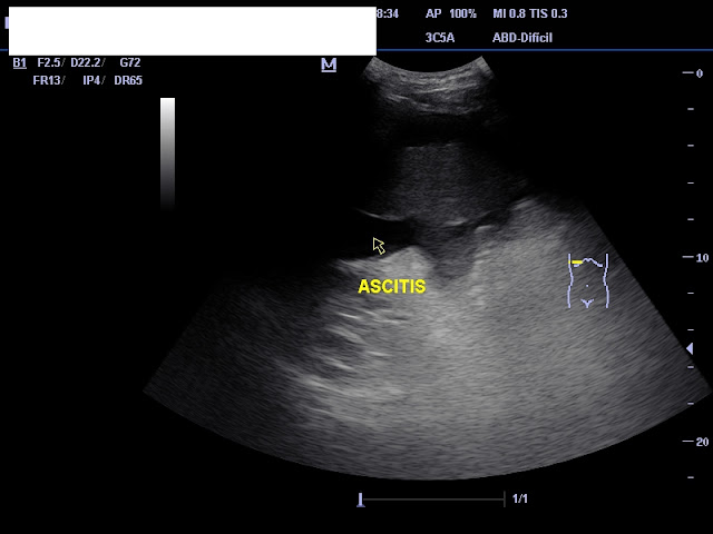 EcoCyl-Grupo: Ascitis