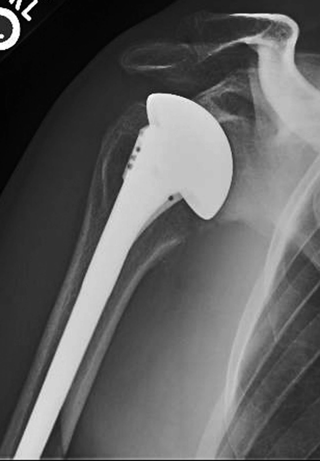 UW Shoulder and Elbow Academy: Shoulder arthroplasty infection with ...