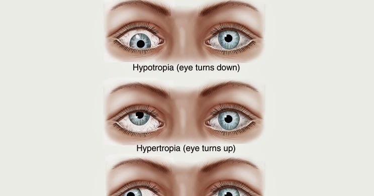 Test empleados en optometria : HETEROTROPIAS