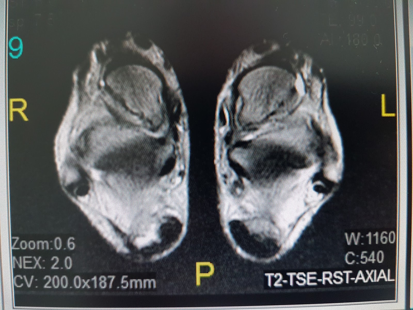 Podo Basas al Día: Fascitis plantar con Topaz. Espolón calcáneo. Rotura ...
