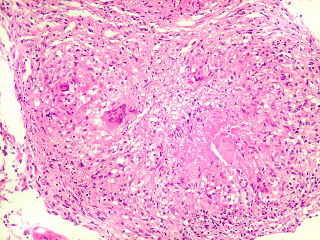 necrose caseosa - wood scribd braxin