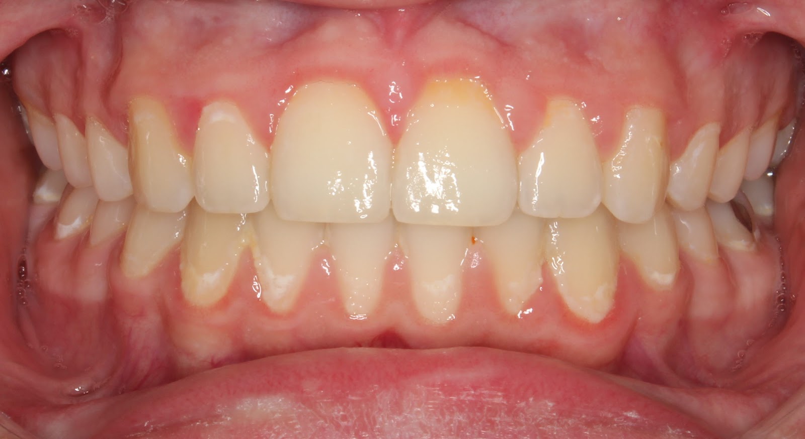 St Clair Orthodontics, Damon braces, Invisalign: Before and After: Ty ...