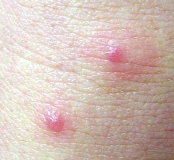 Scrub Typhus's first caseconfirmed from Central India