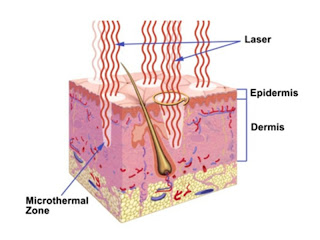Lasers for Keloid Scar Reduction