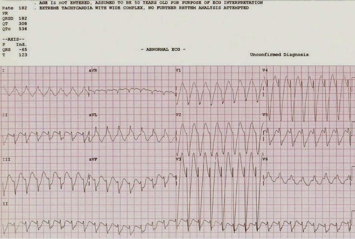 Adult Emergency Medicine: Broad Complex Tachycardias