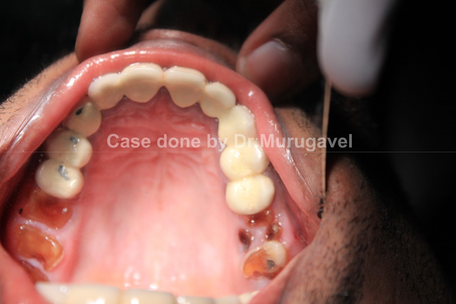DR Murugavel's dental implant course: Upper Bilateral Decayed Molars ...