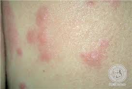 Como curar picadas de percevejos - Artigos sobre saúde