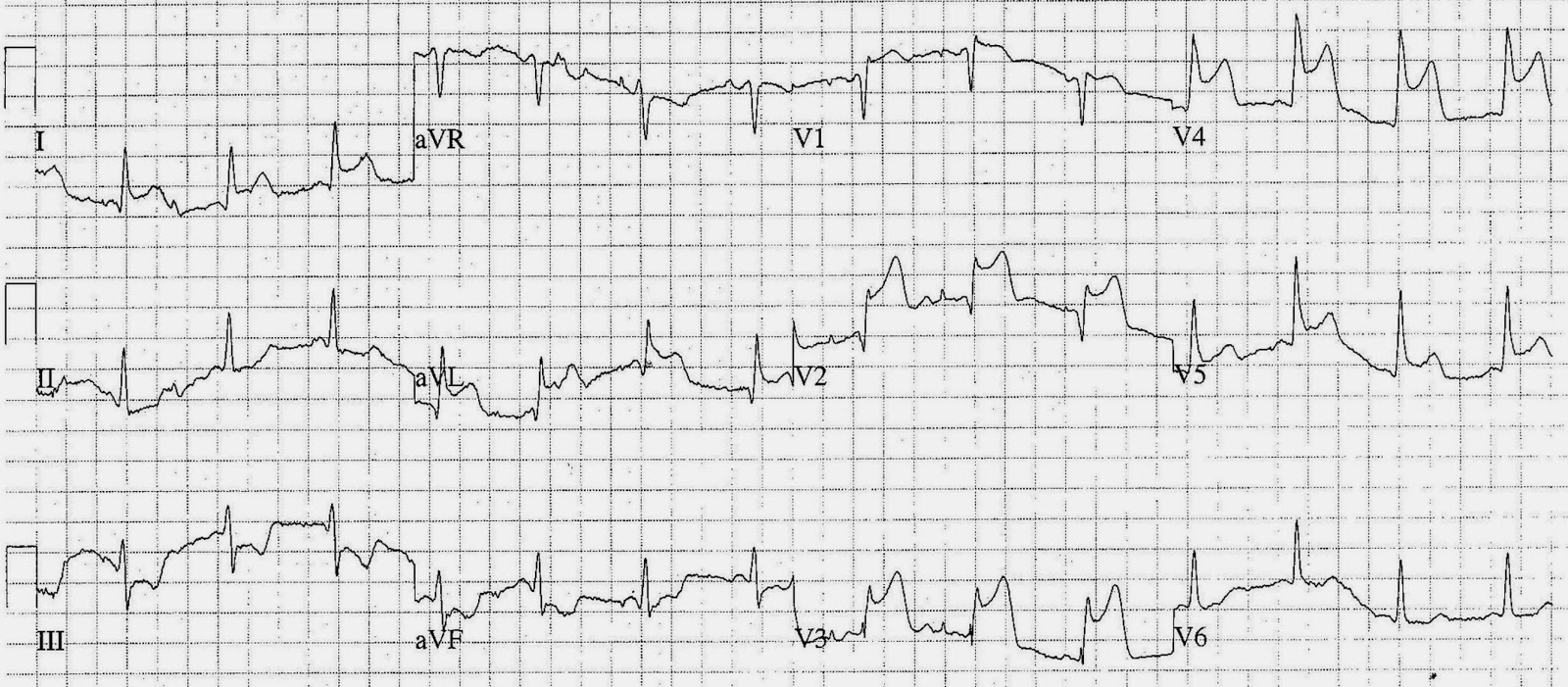ECG of the Week: ECG of the Week - 17th March 2014 - Interpretation