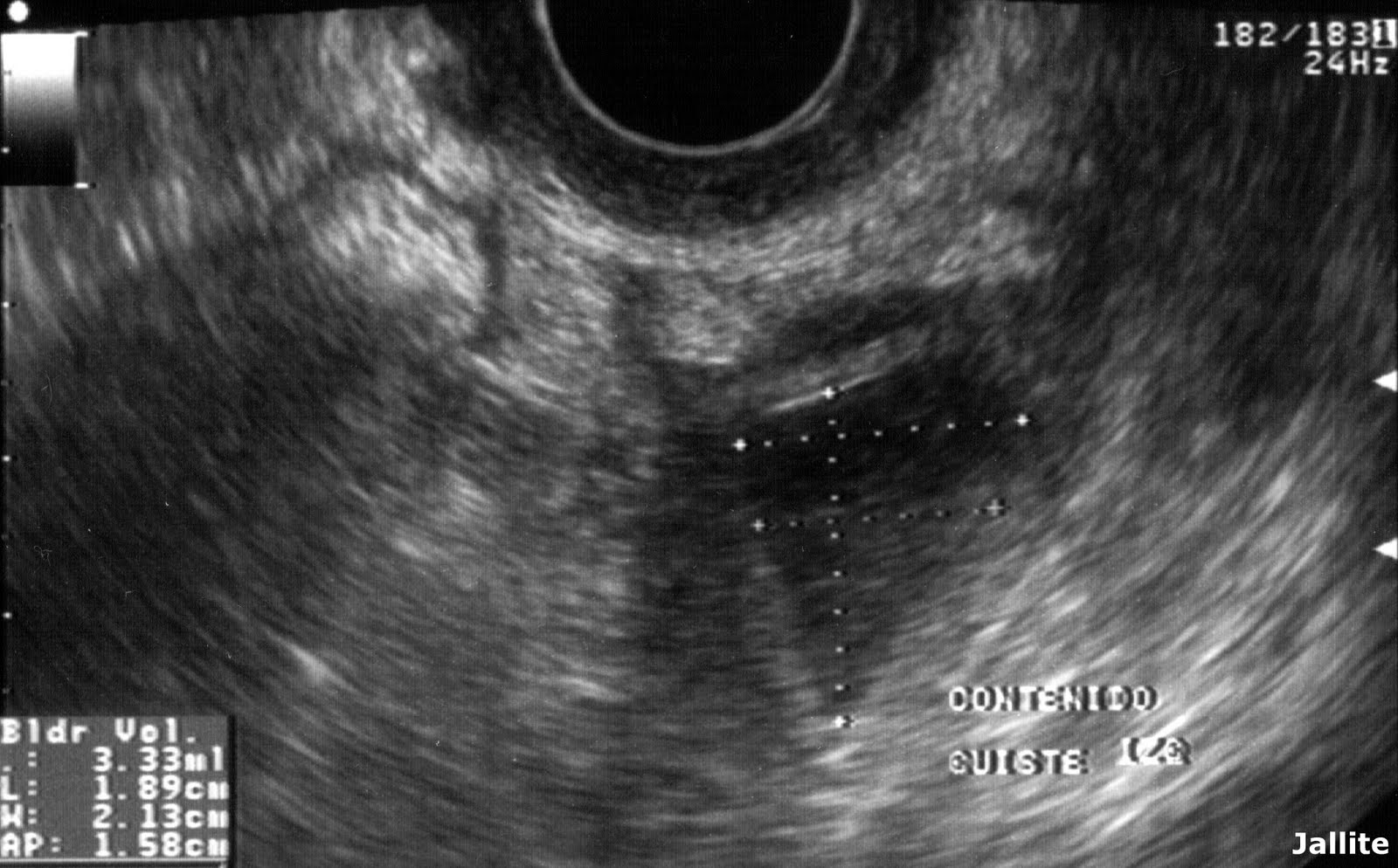 Diario de un Medico II: Quistes Ovaricos