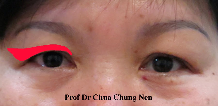 Eyelid Surgery by Prof Dr CN CHUA 蔡鐘能: Alternative to upper ...