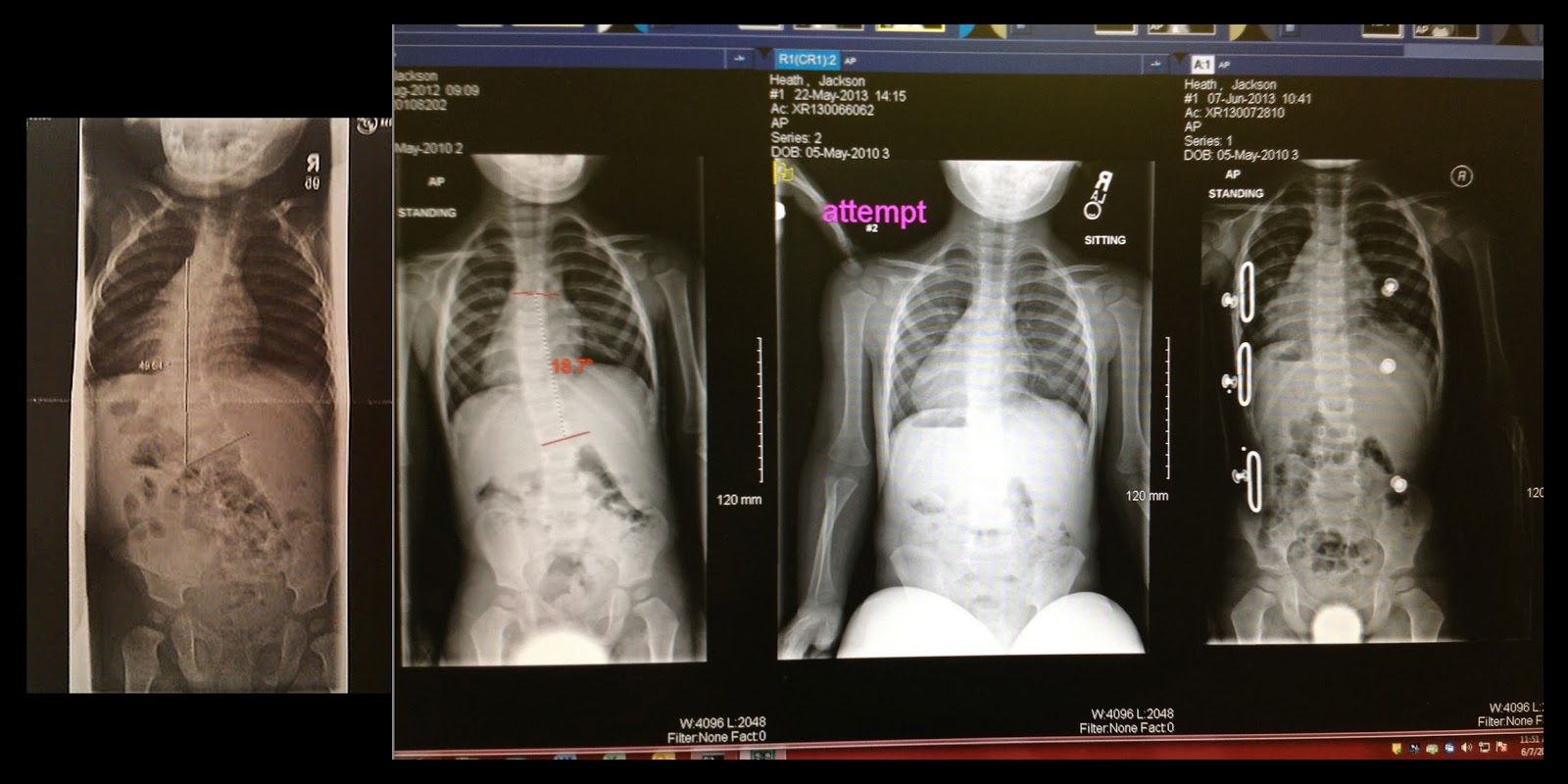 journeys with jax and oliver: Jackson's Brace Fitting