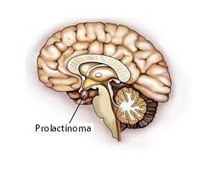Prolactinoma- Symptoms, Causes, Diagnosis & Herbal Treatment - Dr ...