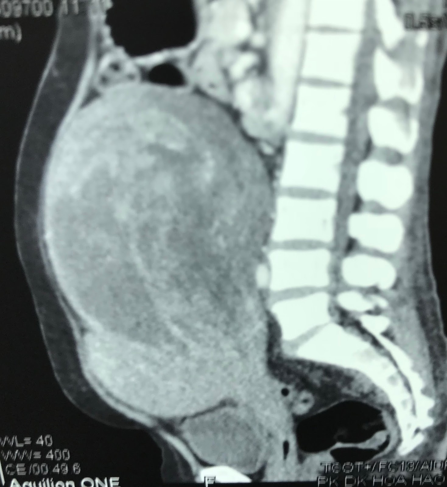 Uterus Myomatosus 1 Doccheck