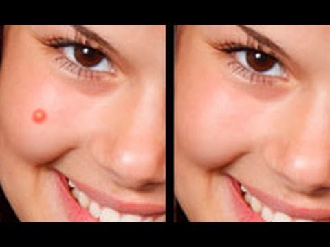 What is cyst also known as Pimple? | KEMPS Skin Clinic