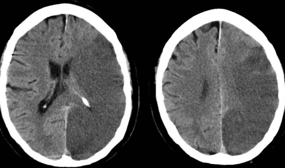 Dr Balaji Anvekar FRCR: Ischemic stroke and Vascular territories of Brain