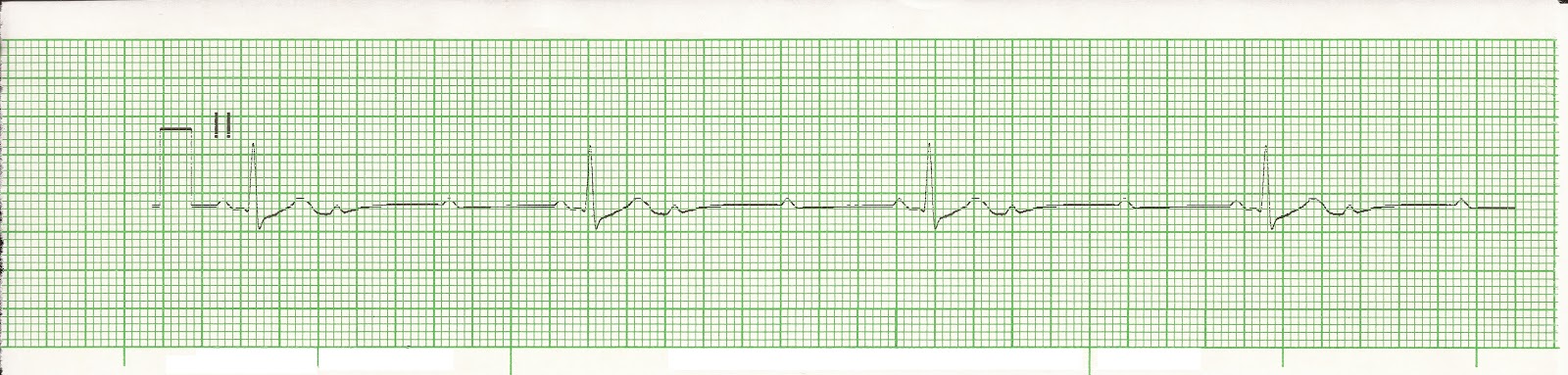 ACLS Rhythms: Heart blocks