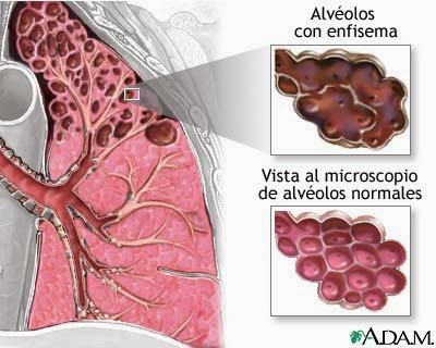 CONSEJOS PARA CURAR DIVERSAS ENFERMEDADES (II): ENFISEMA PULMONAR