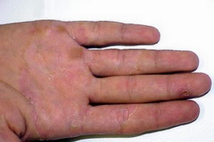 Hand Fungus – Symptoms, Causes, Pictures and Treatment