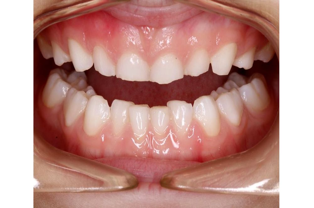 BRUXISMO : Causas del bruxismo infantil - odontobebe