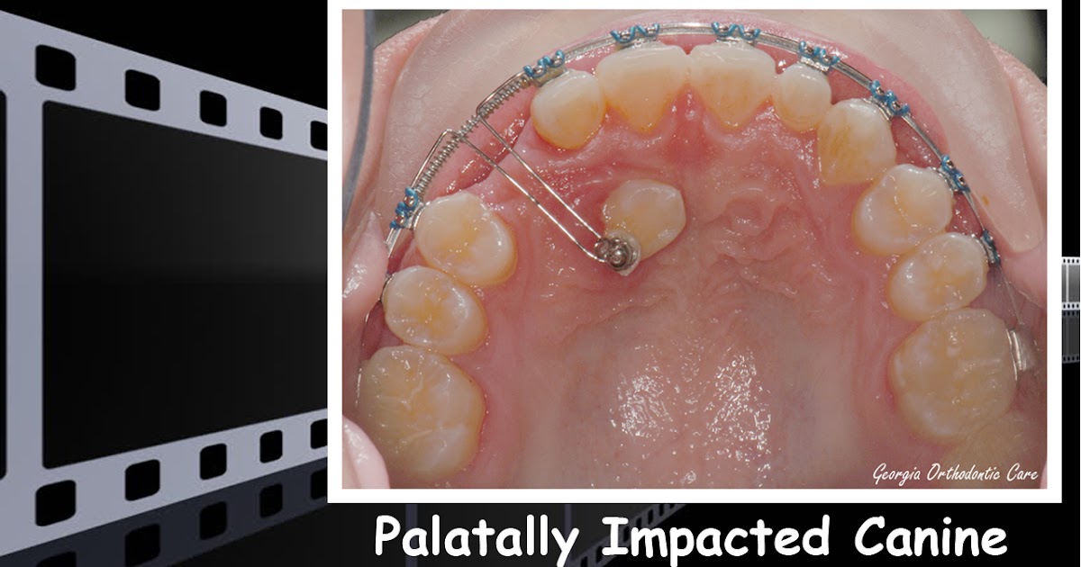 GEORGIA ORTHODONTIC CARE - LAWRENCEVILLE & NORCROSS GA: Palatally ...