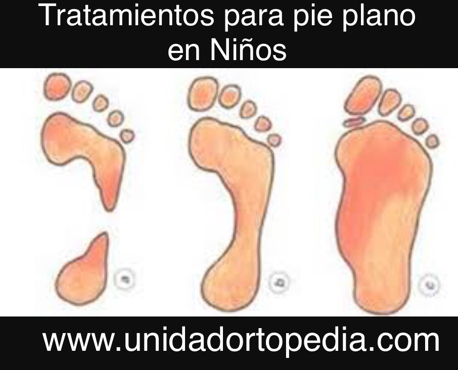 PIE: CLINICA PARA EL PIE PLANO EN NIÑOS