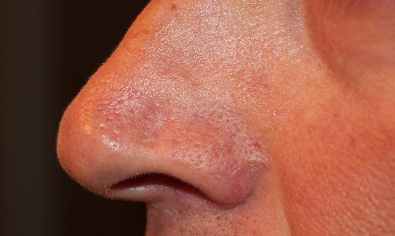 Basal Cell Carcinoma Cancer on My Nose - Mohs Surgery