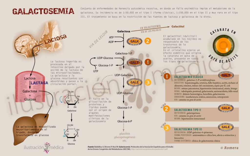 Galactosemia: Alteraciones de la replicación en la galactosemia