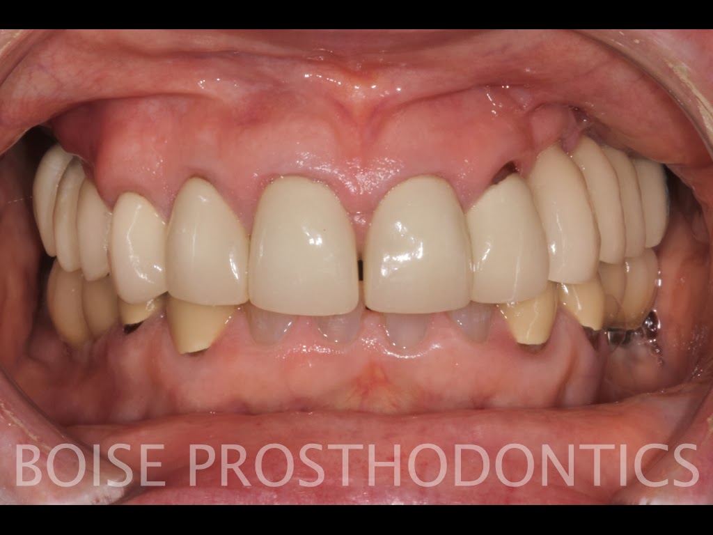 Boise Idaho Prosthodontics: Posterior Provisional Zimmer Implant ...