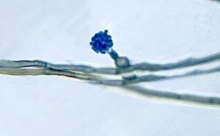 Um Convite à Biomedicina: Cromoblastomicose e suas relações clínicas