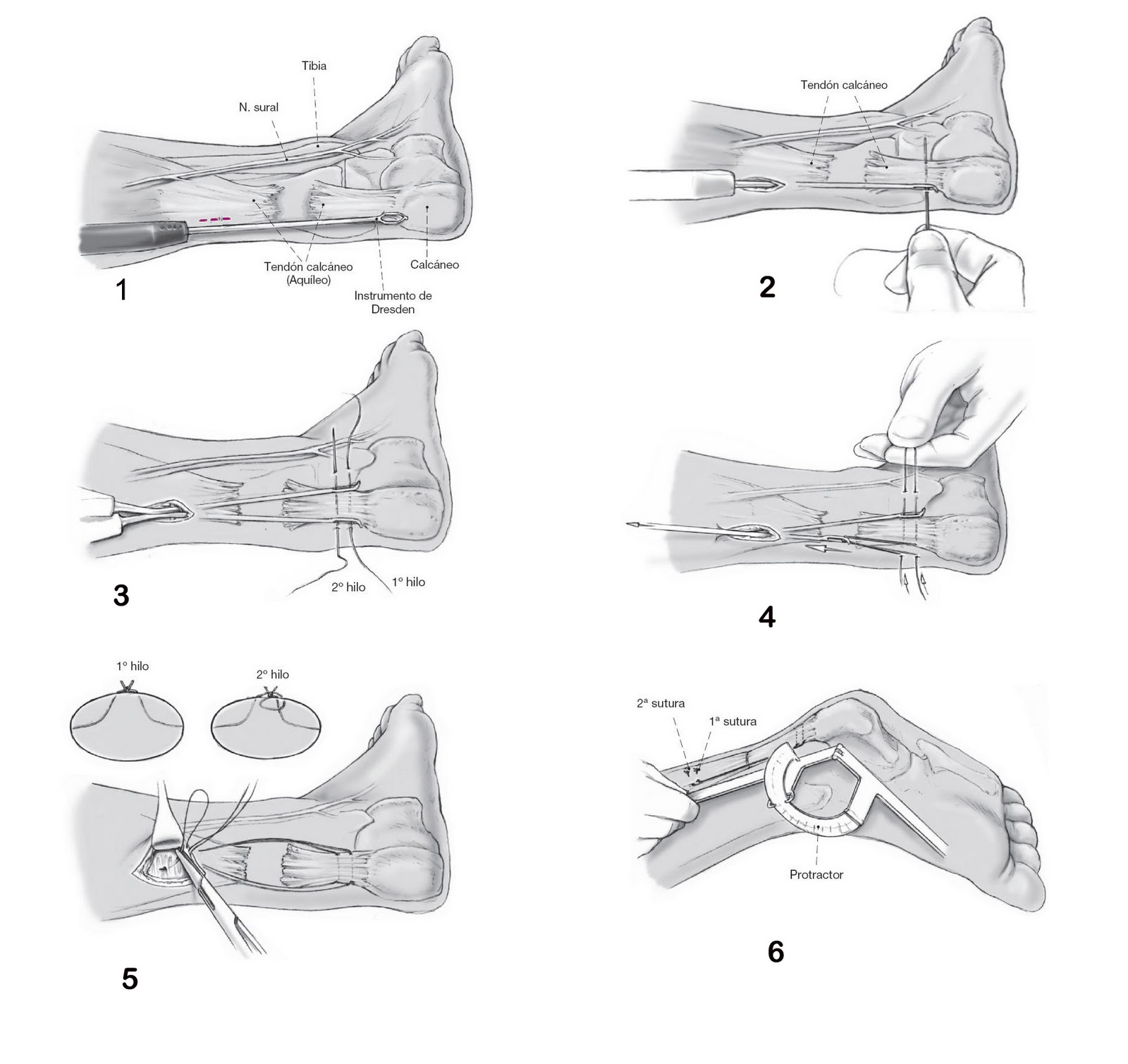 Mi tendón de Aquiles: Tenorrafia percutanea (tendon de aquiles)