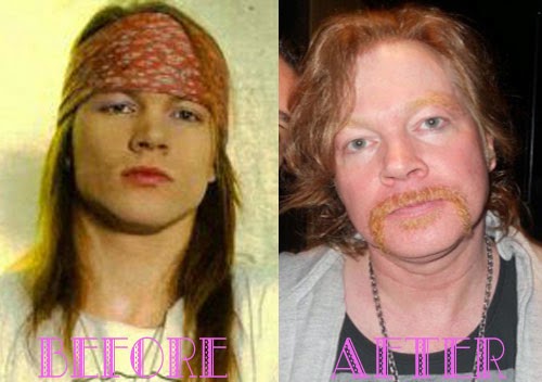 Axl Rose Plastic Surgery Before and After Facelift, Nose Jobs Images