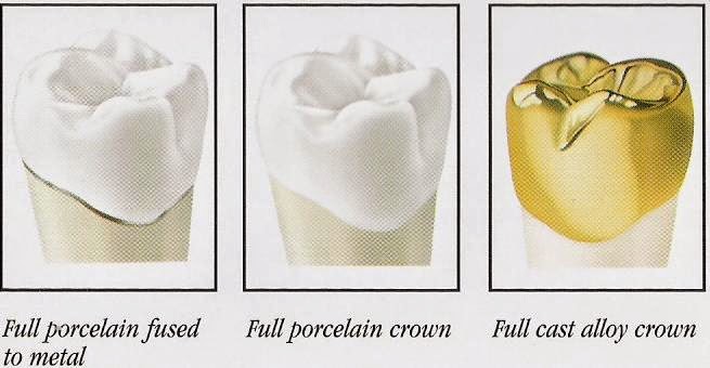 Omni Dental Group: Crowns: An Overview