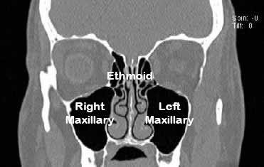 How to Read a CT Sinus Scan for the Layperson | Fauquier ENT Blog