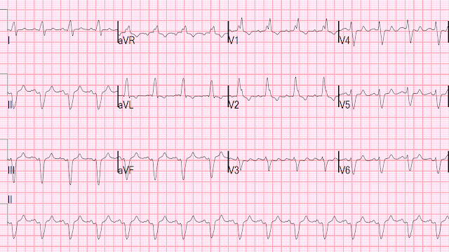 Dr. Smith's ECG Blog: Very Wide and Very Fast, What is it? How would ...