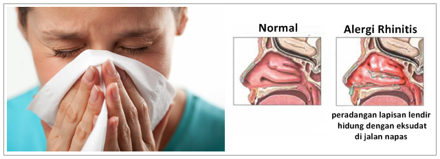 Obat Rhinitis - Cara Mengobati Penyakit Alami
