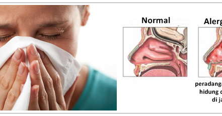 Obat Rhinitis - Cara Mengobati Penyakit Alami