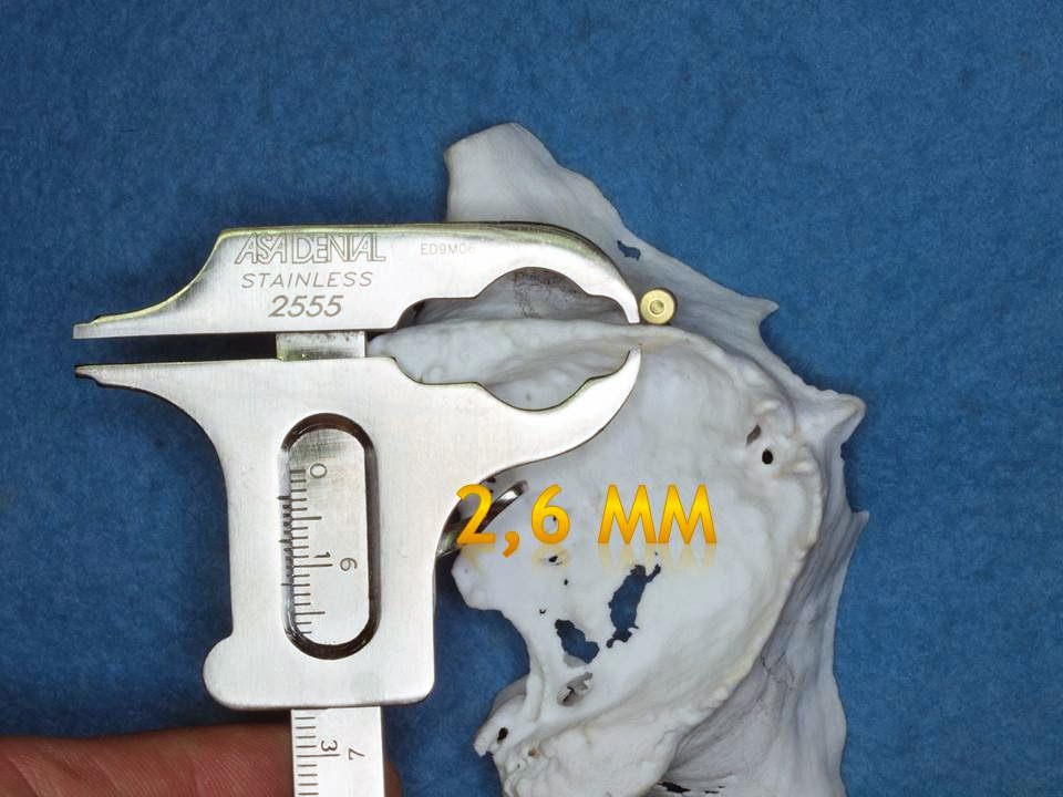 Escuela Implantológica Campos Clinicae: Injerto en Bloque Autólogo