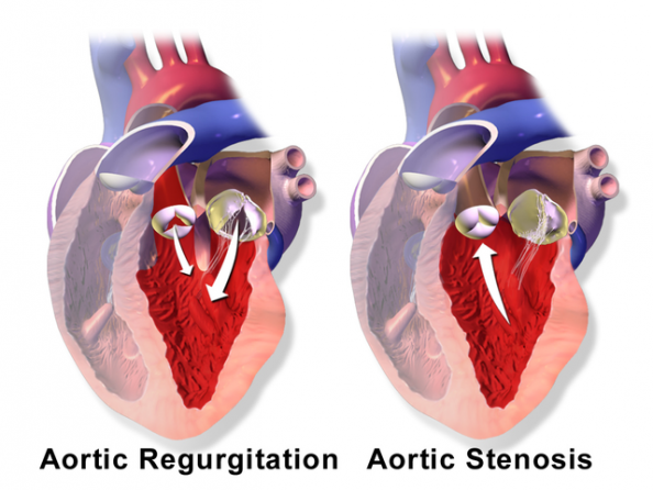 REGURGITASI AORTA - Panduan Praktik Klinis Jantung dan Pembuluh Darah