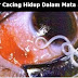 4 Gambar Cacing Hidup Dalam Mata - Harian Metro Online