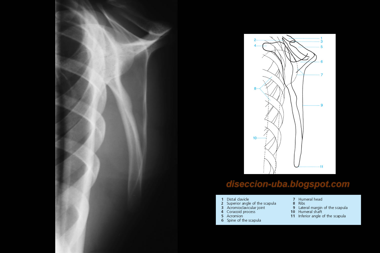 rx: Rx escápula vista lateral