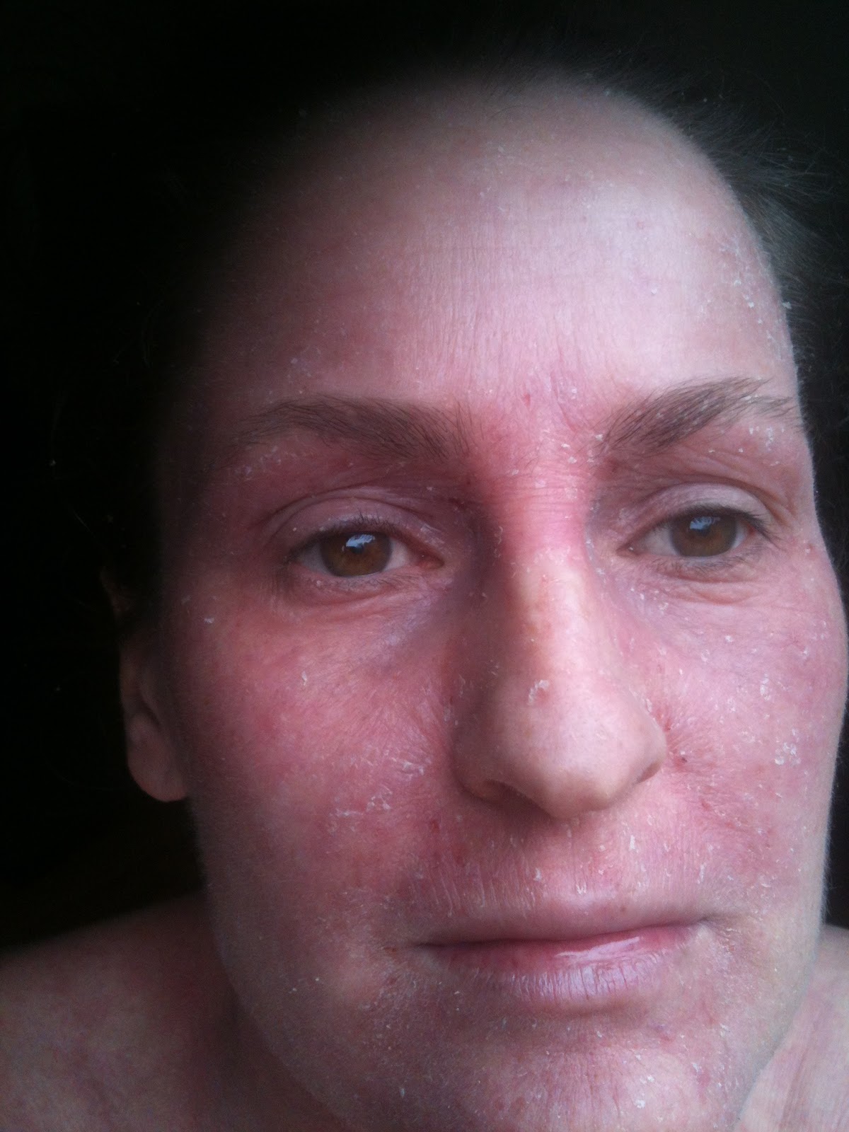 Topical Steroid Withdrawal Journey-Healing Eczema and Red Skin Syndrome