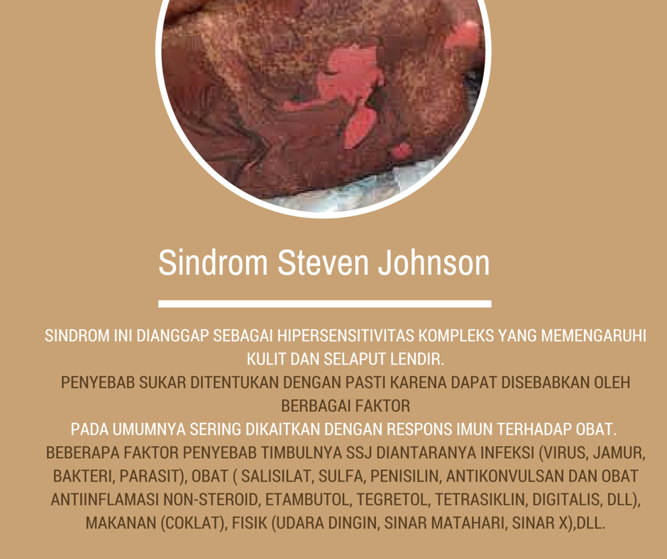 Sindrom Steven-Johnson - Infografis Kesehatan