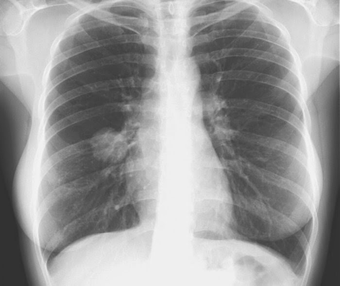 NODULO PULMONAR : TODO SOBRE SALUD Y ENFERMEDADES