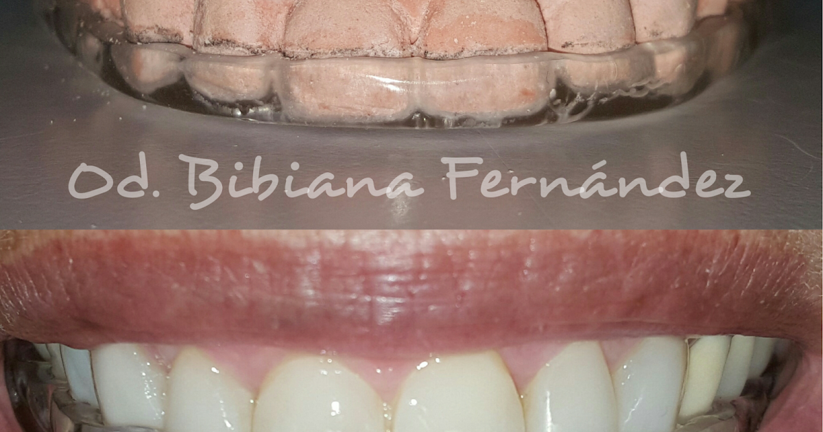 ODONTOESTETICA A TU ALCANCE: FÉRULA OCLUSAL. Caso Clinico.