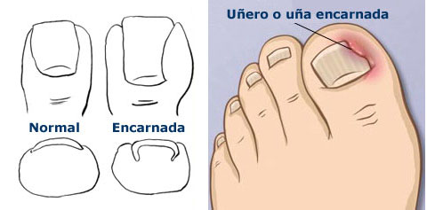 Mundo FiLi: Qué hacer con una uña encarnada en niños