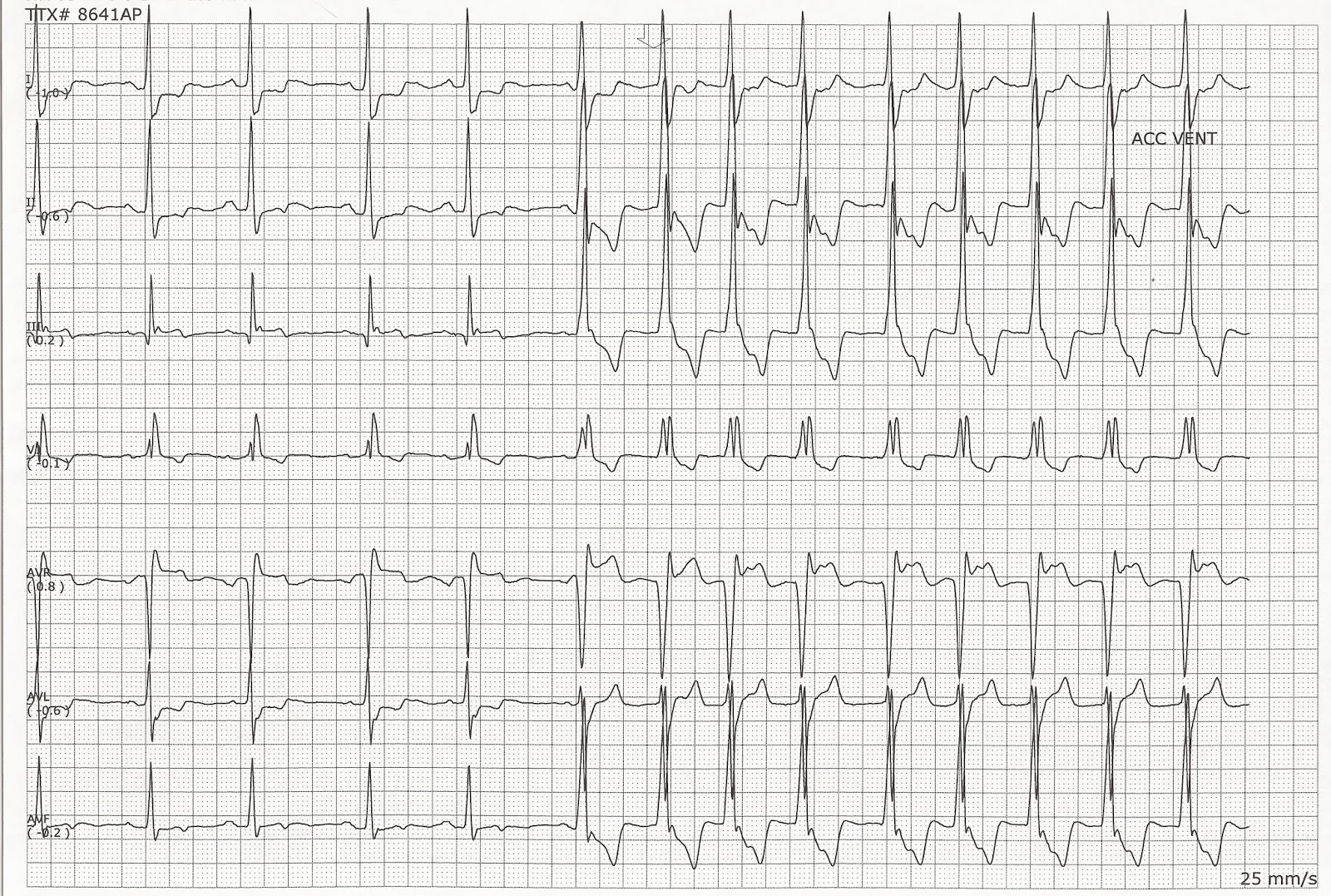 Sinus rhythm changing to accelerated idioventricular rhythm