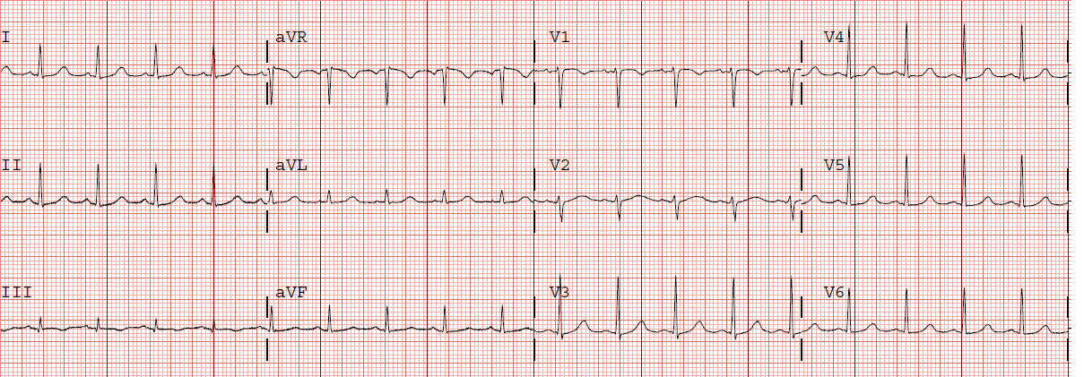Dr. Smith's ECG Blog: Slightly Peaked T-waves, What is it?