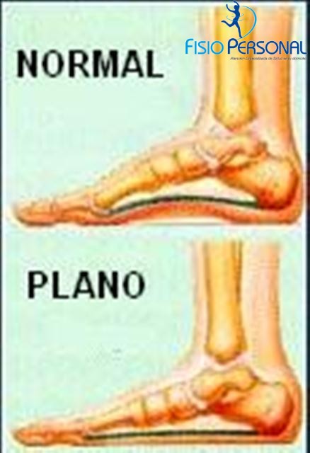 Fisiopersonal: Consecuencia del pie plano en el adulto